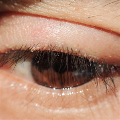 Demodex Blepharitis Symptoms Causes And Treatment Explained