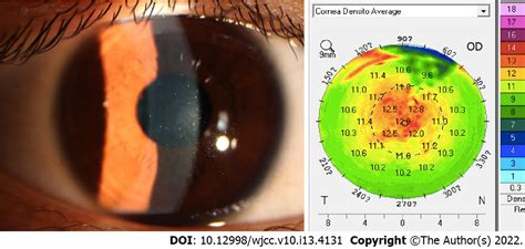 Diffuse Lamellar Keratitis