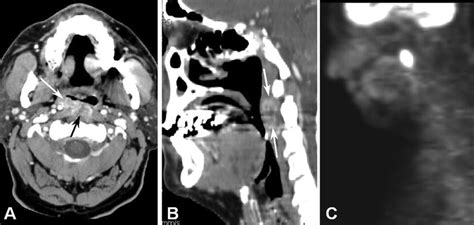 Presumed Pharyngeal Teflon Granuloma Case 2 A Contrast Enhanced