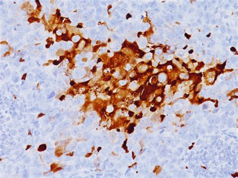 Hif 1 Alpha Antibody Biocare Medical