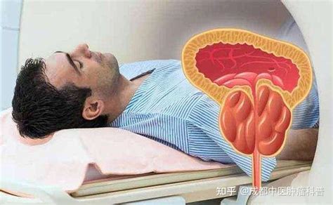 成都中医肿瘤医院段心好：前列腺癌术前术后护理注意事项 知乎
