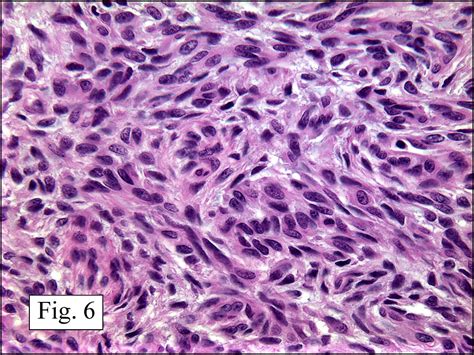 April 2009 A 43 Y O Woman With Multiple Uterine Masses And Left