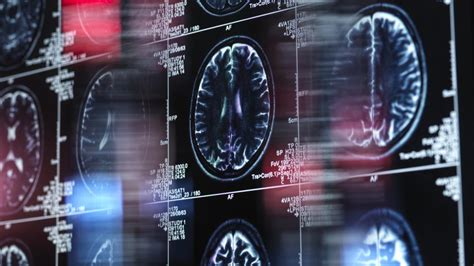 Día Mundial del Alzheimer 2023 estas son las señales para un detección