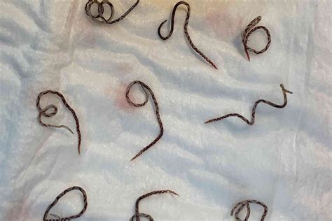 Australian Warning For A Rise In Devastating Rat Lungworm Disease