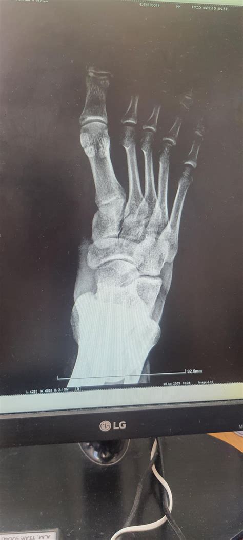 Something Uncommon To Share Os Naviculare Fracture R Radiology
