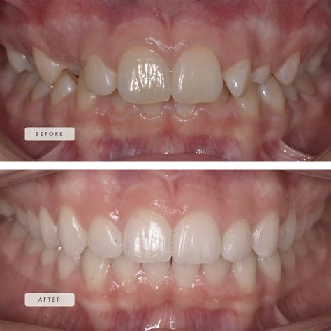 Class Ii Functional Case Herbst Appliance — E Line Orthodontics