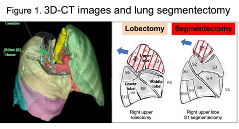 Surgery Thoracic ｜human Sciences｜graduate｜shinshu University School Of Medicine Graduate School