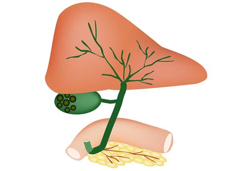 Ayurveda For Gallstones At Terri Kent Blog
