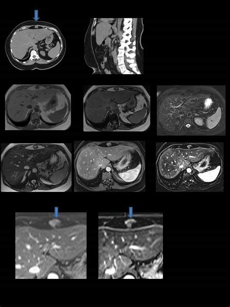 The Radiology Assistant Liver Segmental Anatomy