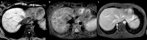 Sinusoidal Obstructive Syndrome Sos A 26 Year Old Woman Treated With