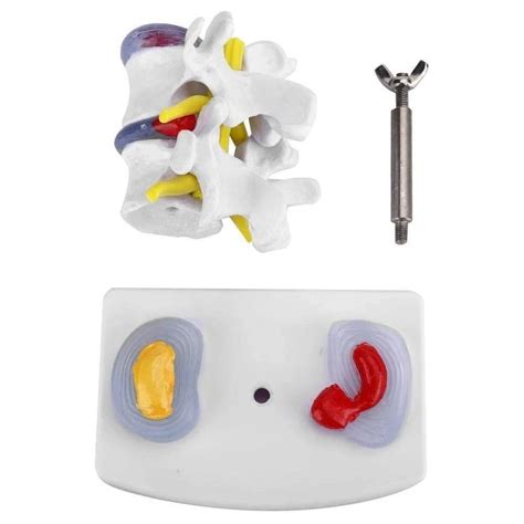 Intervertebral Disc Herniation Bone Pathology Model Lumbar Spine Bone