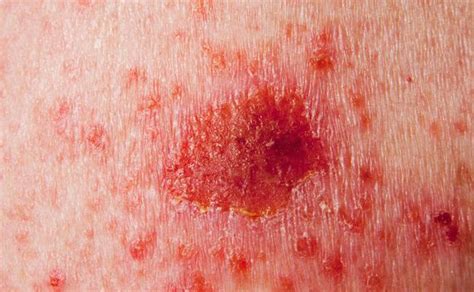 Petites Taches Rouges Sur La Peau