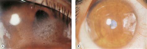 Role Of Surgery In The Patient With Uveitis Clinical Tree