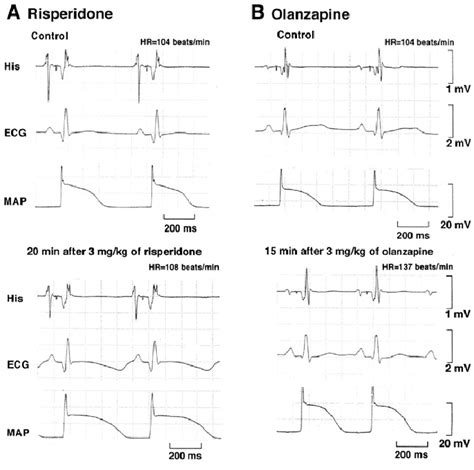 Typical Tracings Of The His Bundle Electrogram His Surface Lead Ii