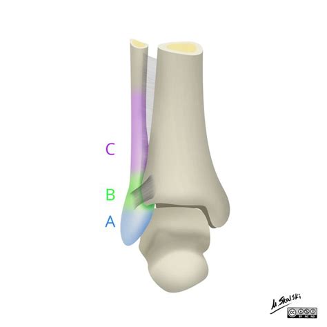 Weber Ankle Fracture Classification Radiology Reference Article