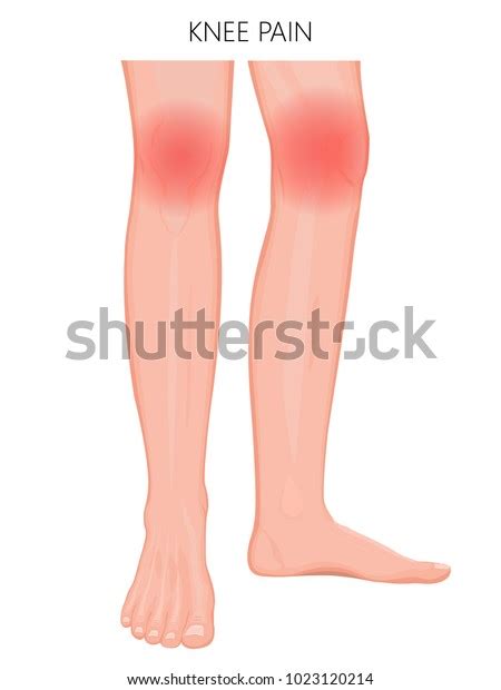 Synovitis Ankle Over 4 Royalty Free Licensable Stock Illustrations
