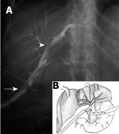 T Tube Cholangiogram