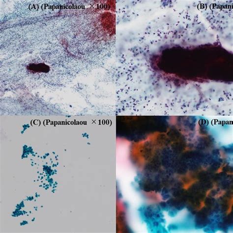 A Flowchart For All Patients Of This Study Ipmn Intraductal Papillary