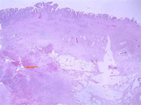 Pathologic Image Of Resected Gallbladder Microscopy Shows The Fistula