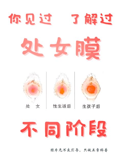 🤔你了解处女膜吗？