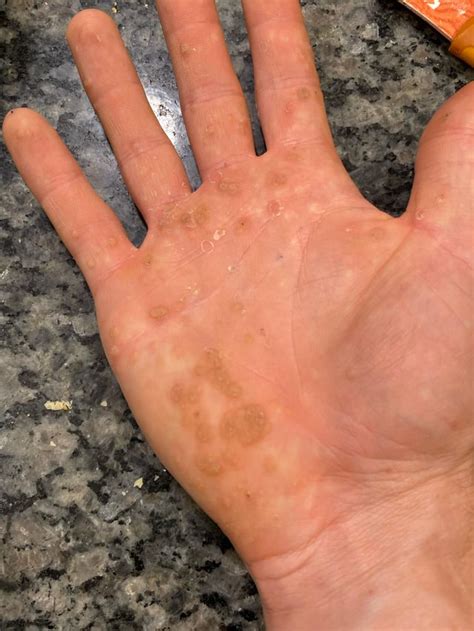 Hundreds Of Seed Warts Help Rwarts