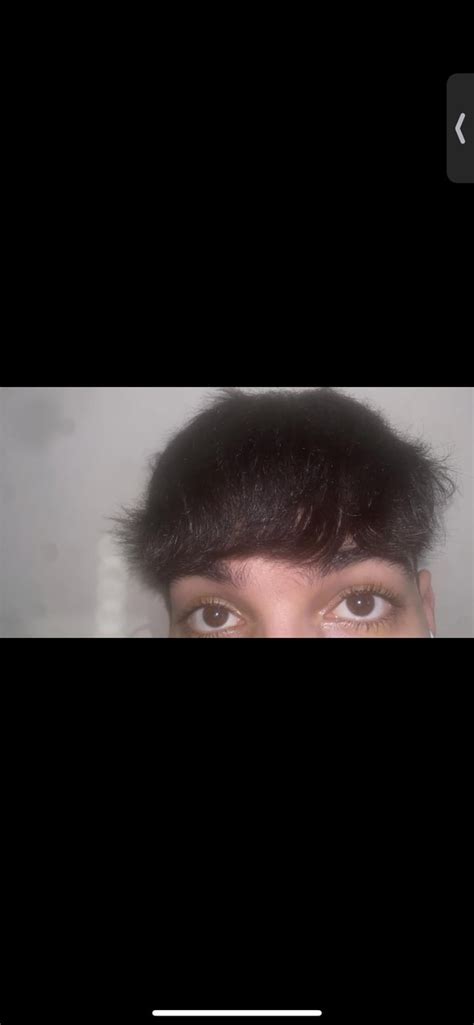 Punctal Plugs Eyes Before And After Rdryeyes