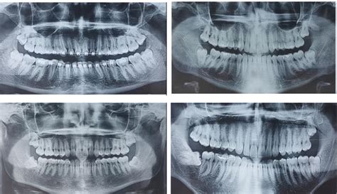 Mesioangular Inclusion Distoangular Inclusion Vertical Inclusion Download Scientific Diagram