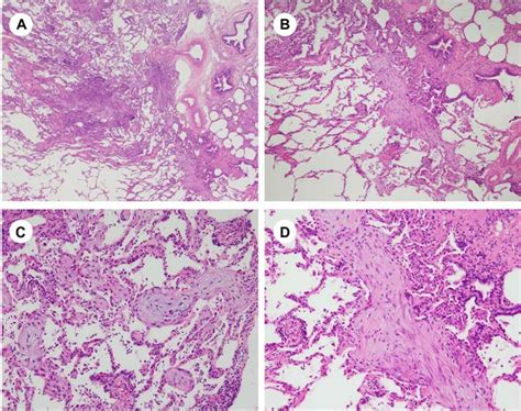 Pathology Of Cryptogenic Organizing Pneumonia Cop A The