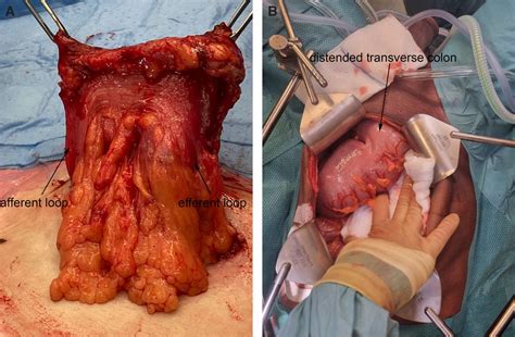 Transverse Colostomy