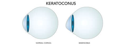 What Is Keratoconus Dr Angela Bergin Explains
