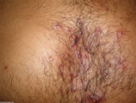 Global Skin Atlas Diagnosis Detail