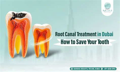Root Canal Treatment In Dubai How To Save Your Tooth Mint Dentals Care