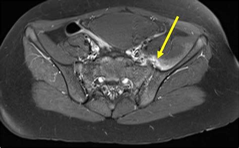 Pyogenic Sacroiliitis And Pyomyositis Caused By Streptococcus