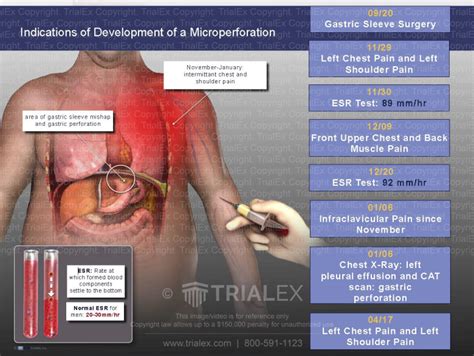 Indications Of Development Of A Microperforation Trialquest Inc