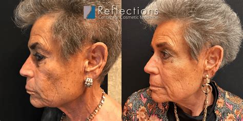 Cheek Filler Looks Different Over 70 Before And After Photos New Jersey Reflections Center