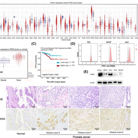 Expression Of Psma In Prostate Cancer A Folh1 Gene Expression Was Download Scientific