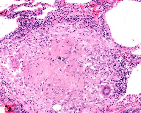 Granuloma In Lungs When Should I See A Doctor