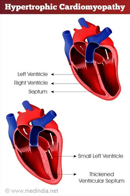 Hypertrophic Cardiomyopathy Quotes Ulsterman Who Discovered How Elvis