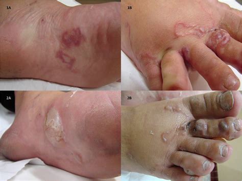 Cutaneous Larva Migrans