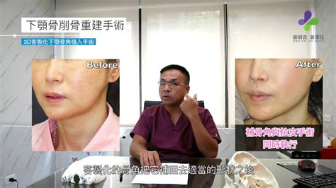 下顎骨削骨是否會下垂謝明吉院長詳細說明 Youtube