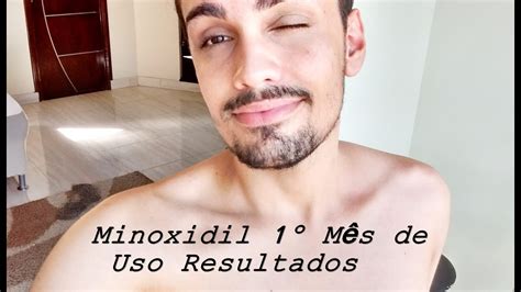 Minoxidil 1º Mês de Uso Resultados YouTube