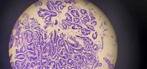 Site Fundus Clinical Dx Fundic Gland Polyp Rpathology