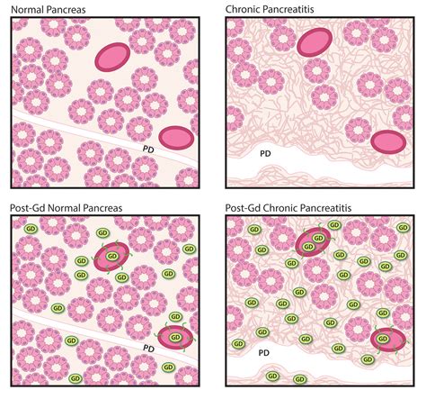 Chronic Pancreatitis Histology