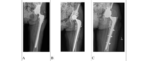 A Revision Tha With Septic Loosening Of A Custom Made Shell With Download Scientific Diagram