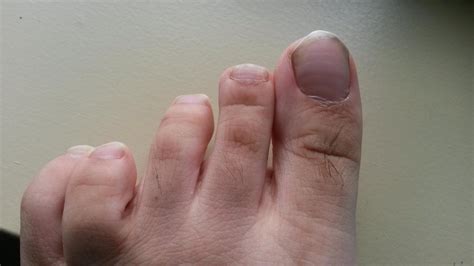 What Do Horizontal Lines On Toenails Mean Design Talk