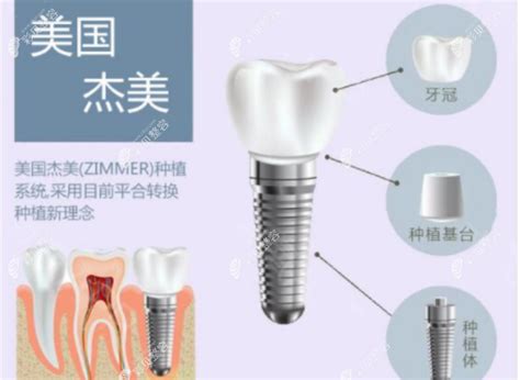 美国杰美种植体怎么样？zimmer这款纯钛种植体和皓圣哪个好 整容资讯 彩贝整容网