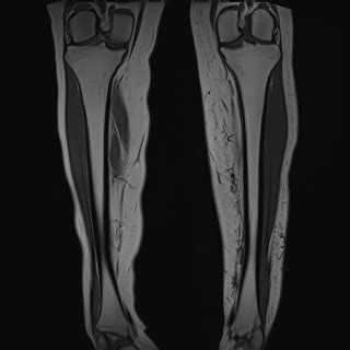 File Medial Gastrocnemius Head Tear Grade 3 Radiopaedia 67245 76602