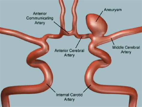 Brain Aneurysms Treatment Service In Bengaluru Id 15378268712