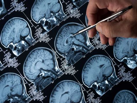 Identifican La Causa De La Progresión De La Enfermedad De Alzheimer En