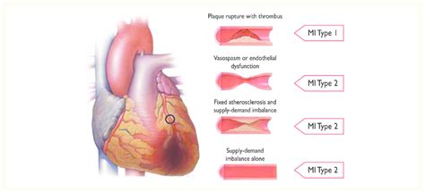 What Are The 5 Types Of Myocardial Infarction Free Printable Template